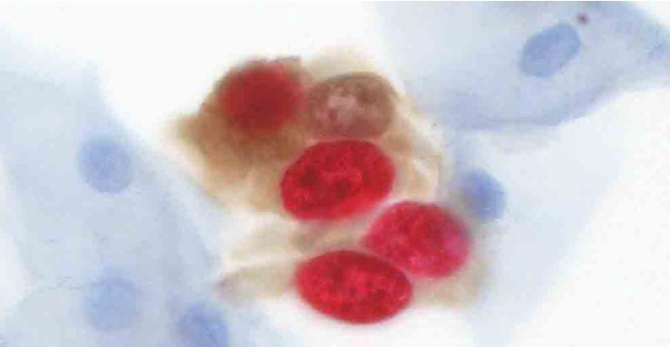 Imunocitodiagnostic CIN2+ (CINtec ® PLUS) - Synevo